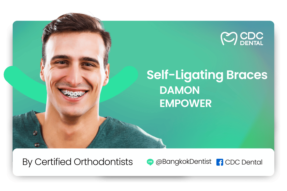 Expert Guide to Damon Braces Thailand | CDC Dental