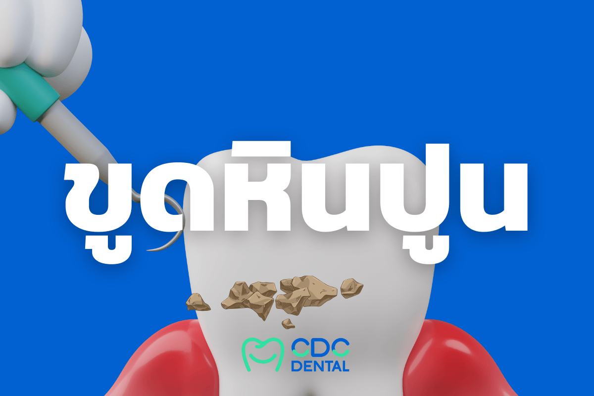 ทันตกรรมทั่วไป อุดฟัน ขูดหินปูน Air Flow ที่ CDC Dental